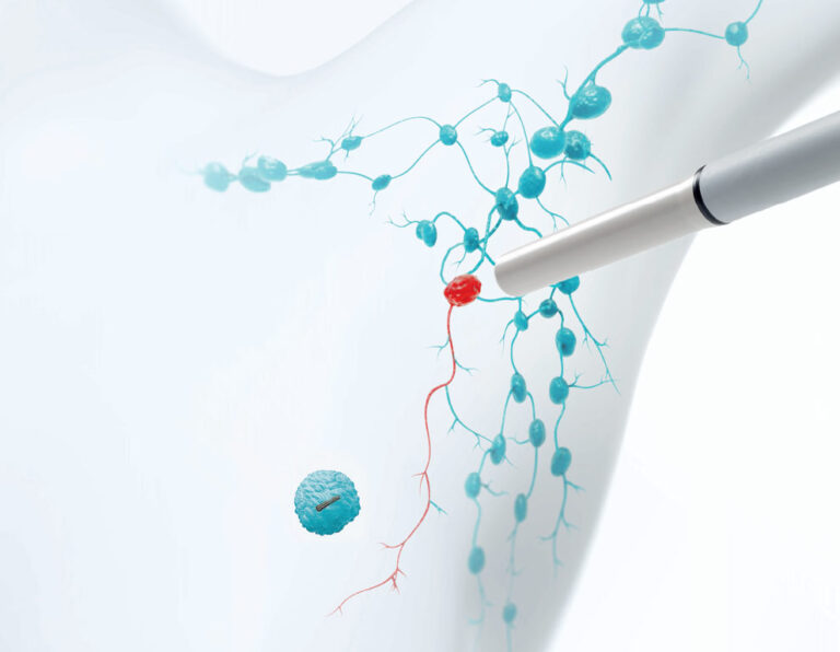 Sentimag® - Magseed® - Hospital Magazine - Leading Healthcare Magazine ...