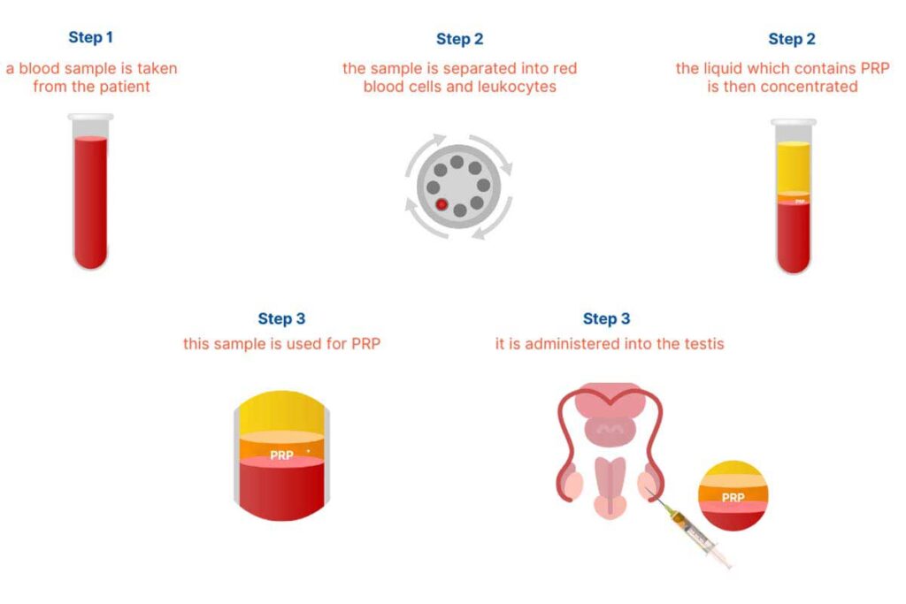 Testicular PRP: A New Hope for Treating Male Infertility - Hospital ...