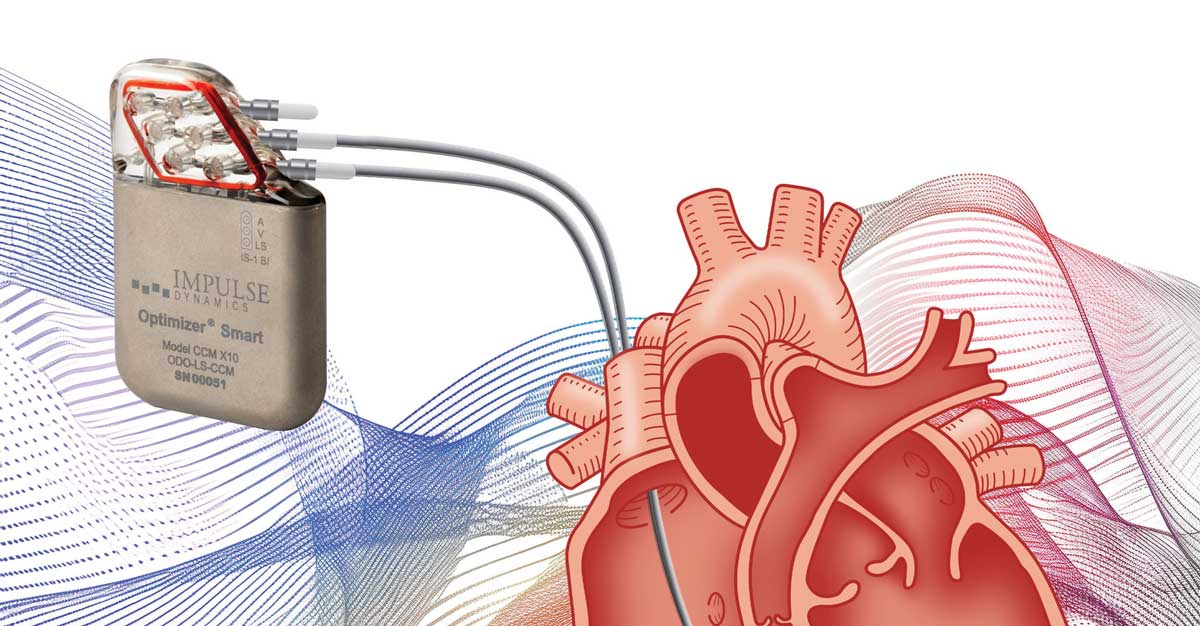 New Implantable device treats heart failure - Hospital Magazine ...